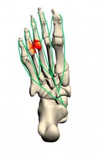 Maladie de Morton | Ostéopathe Saint Maur